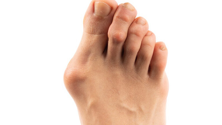 Hallux Valgus - Fysiotherapie Hoogeveen